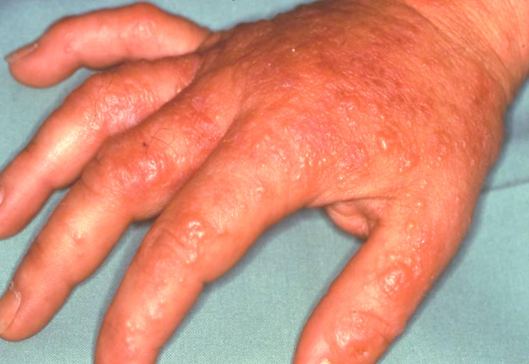 Eczéma de contact, ces molécules qui en veulent à notre peau !, Fonds ...