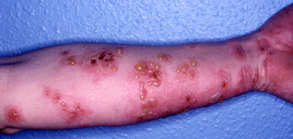 Fonds de Dotation pour la recherche en Dermatologie