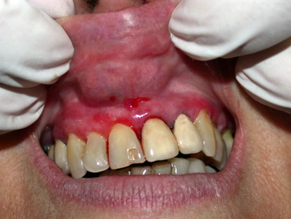 Incidence et mortalité de la pemphigoïde des muqueuses en France, Fonds ...