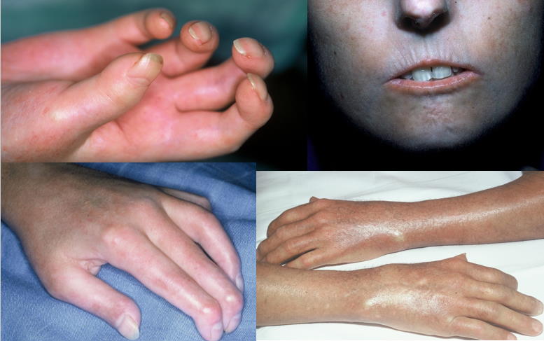 Étude des interactions lymphocytes B/ modèle 3D de peau au cours de la ...